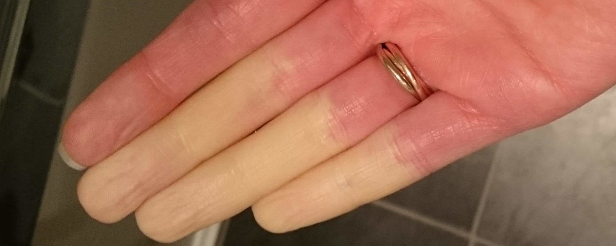 Living with Raynaud's: Raynaud's Awareness Month 2020 - BAD Patient Hub