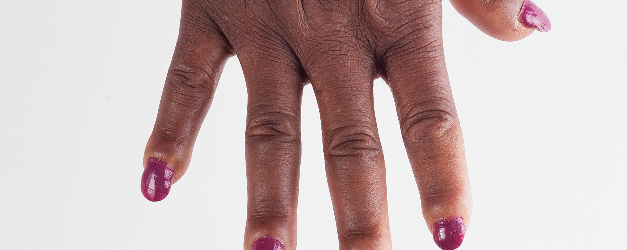 Living with scleroderma during the time of COVID-19 - BAD Patient Hub