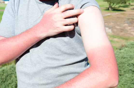 40% of Brits sunburnt in 2022’s extreme heatwave - BAD Patient Hub
