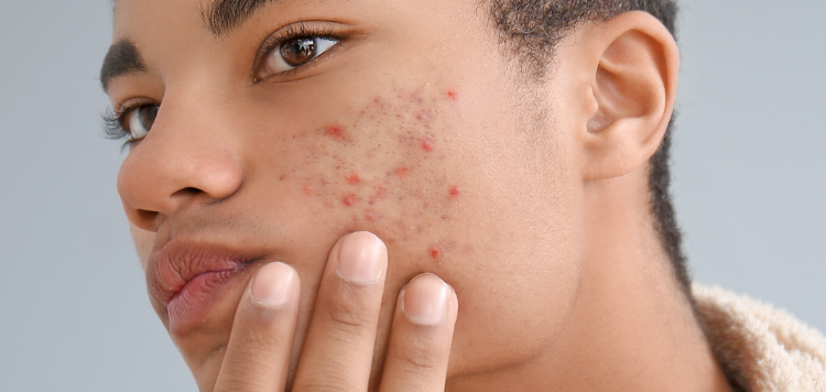 Diagnosis of acne on the rise in the UK and globally since 1990 - BAD ...